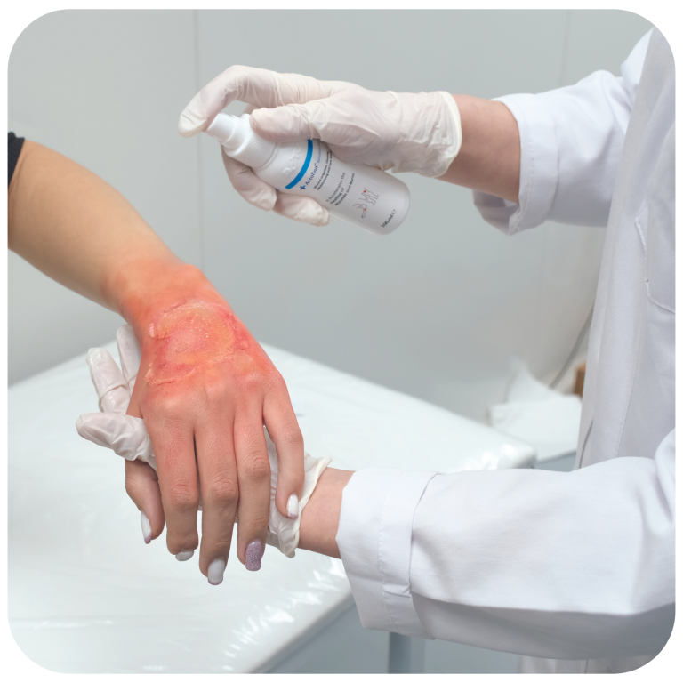 Actolind | Wound Dressing and Care Products